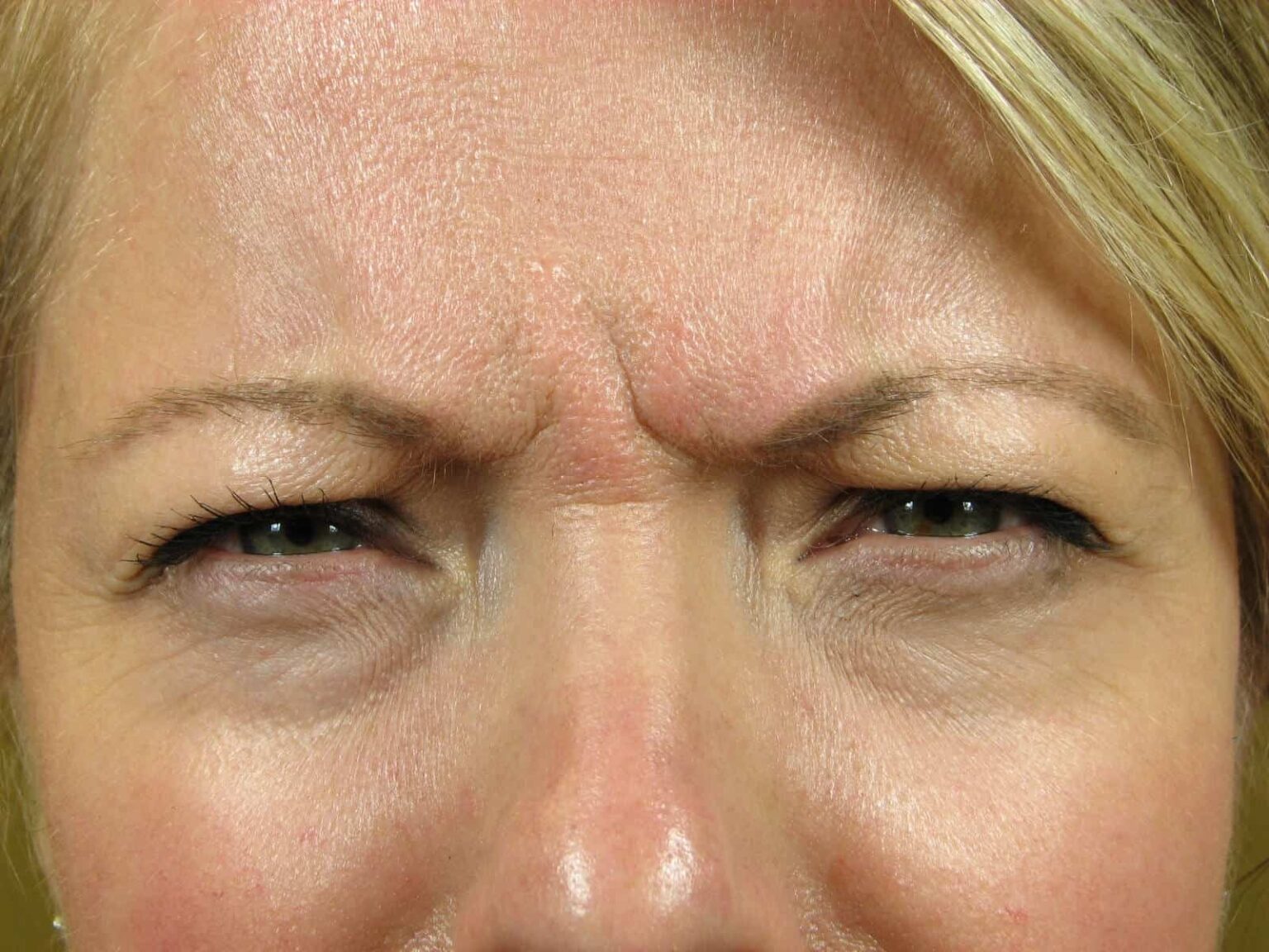 The REAL skinny on Botox: your questions on Botox safety, pricing and ...