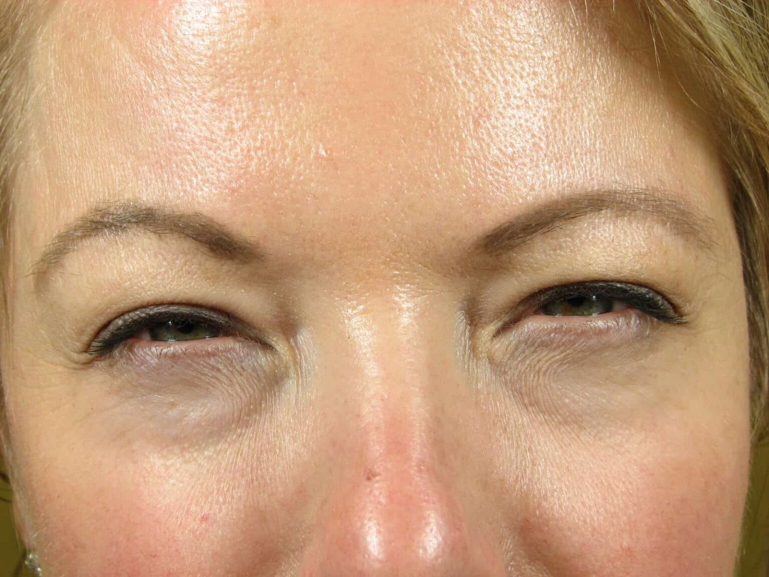 The REAL skinny on Botox: your questions on Botox safety, pricing and ...